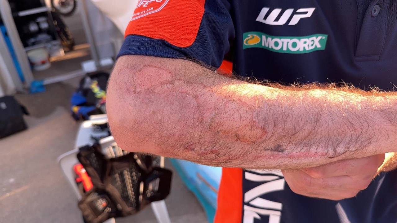 Jeffrey Herlings crasht en verbrandt arm tijdens GP, kijk hier MX ...