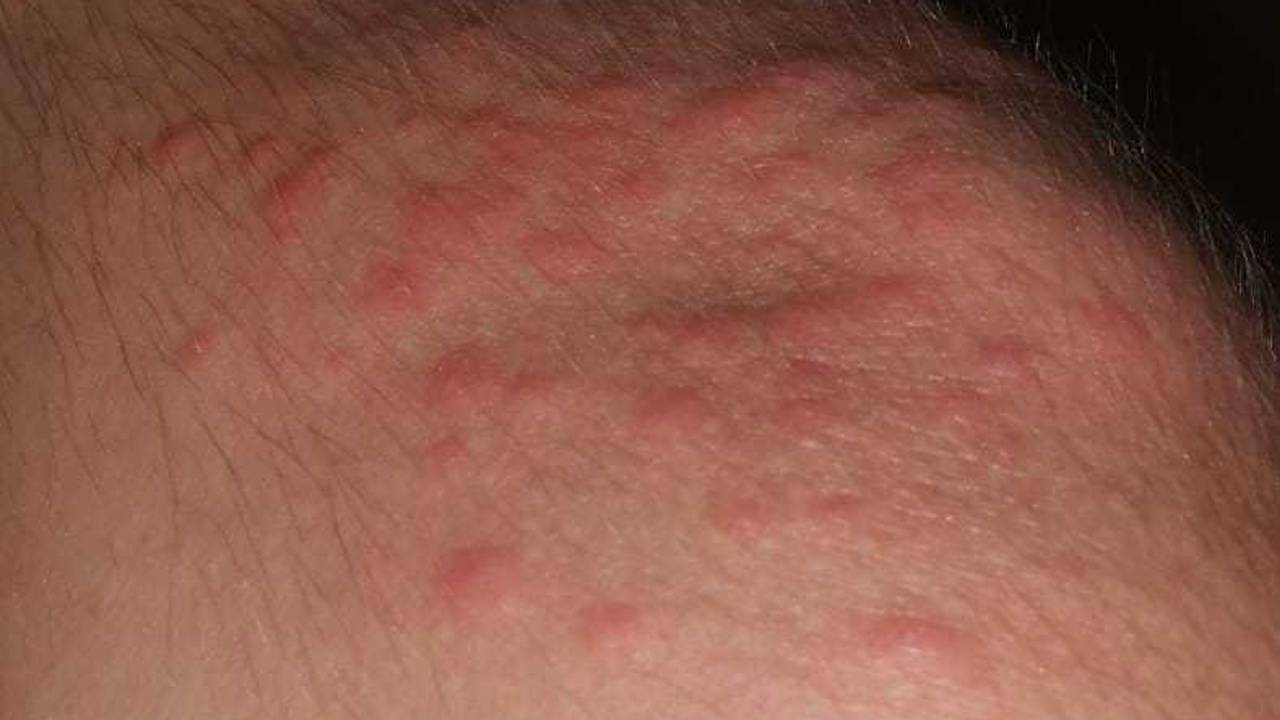 Brandhaartjes van de eikenprocessierups op je huid? Ga op zoek naar een rol plakband! - Omroep ...